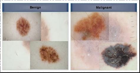 Selected Skin Lesion Samples Showing The Benign Class Left And The