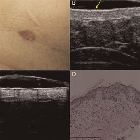 Basosquamous Cell Carcinoma Clinical A Ultrasonographic B C And