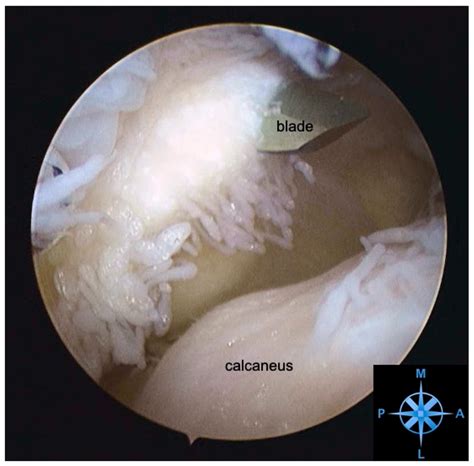 Ab Osteoid Osteoma Of The Calcaneus At The Floor Of The Sinus