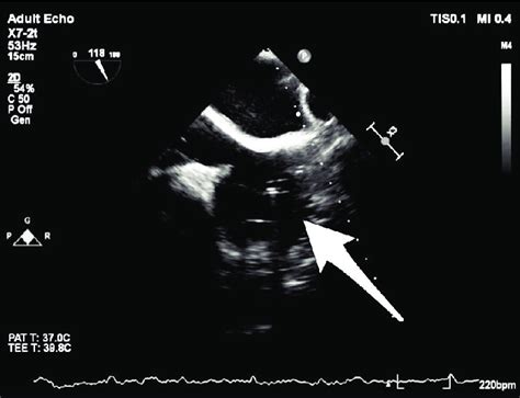 A Highly Mobile Structure Was Shown In The Right Atrium Arrow On
