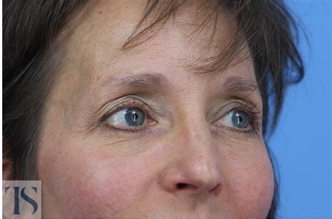 Blepharoplasty Aesthetic Eyelid Surgery In Edina Minnesota