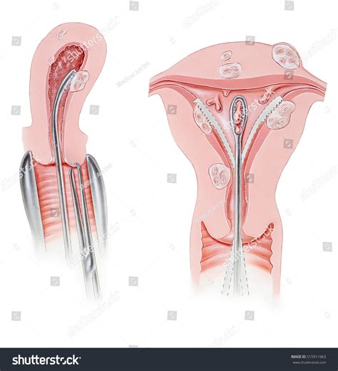 Uterus Dilation Curettage Procedure Stock Illustration 515911963