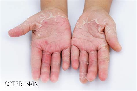 Hand Eczema Causes And Why Your Hands Get Affected More Soteri Skin