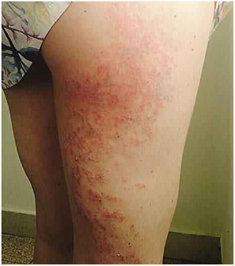 Lichen Striatus Successfully Treated With Oral Cyclosporine Paolo
