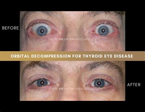 Thyroid Eye Disease Photos Plastic Eye Surgery Associates