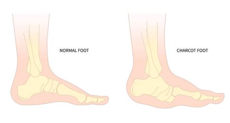 Charcot Foot Uncovered Understanding Treating And Preventing A