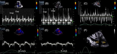 Constrictive Pericarditis Echo