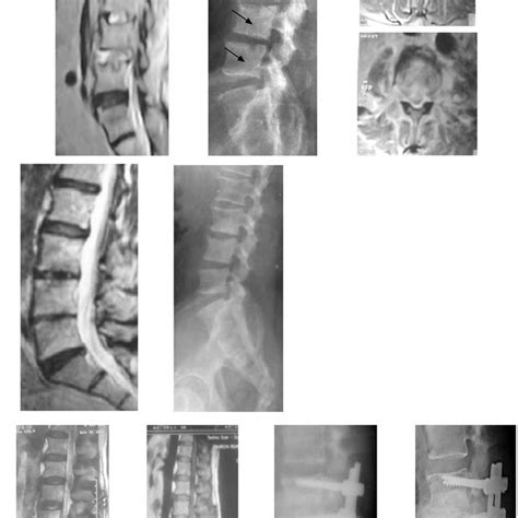 A Male Patient With Decompressive Laminectomy And Post Operative