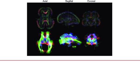 Fetal Diffusion Tensor Imaging Top Row Fibre Orientations
