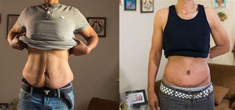 How To Tighten Loose And Sagging Skin After Weight Loss Surgery Vida