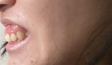 Deep Bite Dental Correction Now Turned Skeletal Rbraces