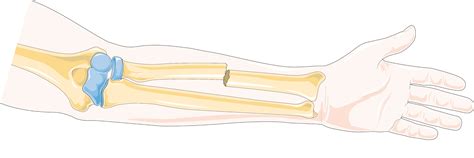 Segmental Fracture Treatment Segmental Bone Surgery