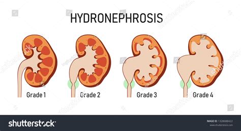 Hydronephrosis Stage Vector Illustration Stock Vector Royalty Free