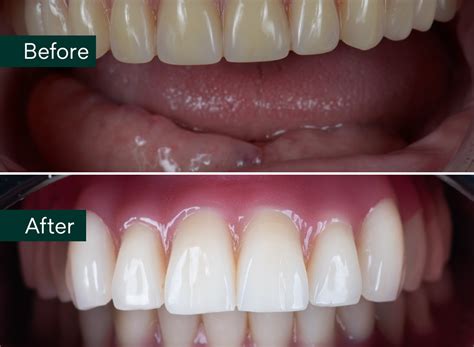 Clinical Case Functional Polyether Impressions For Removable Dentures