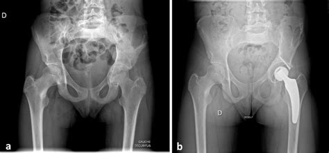 Pre Surgical A And Post Surgical B Evolution Of The Cotyloid