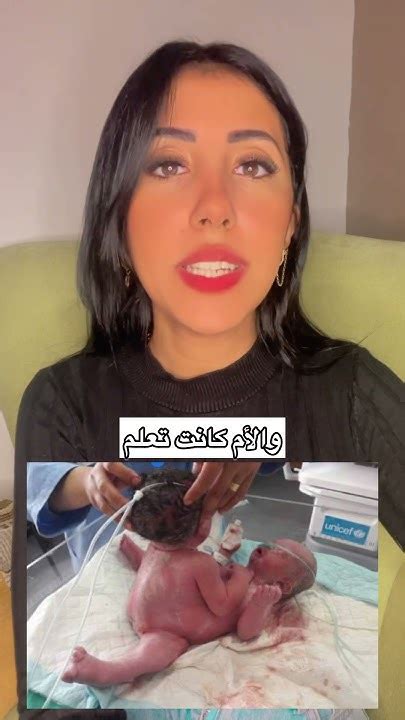 توأم سيامي ملتصق Goviral اكسبلور Fypシ゚ قصص تيكتوك معلومات Youtube