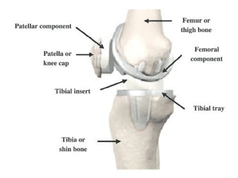 Exactech Knee Recall Lawsuit Knee Replacement Recall Lawyers