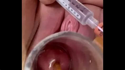 Llorar Mientras El Catéter Atraviesa El Orificio Interno Y Lo Dilata Dolorosamente Con Un Globo