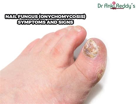 Nail Fungus Onychomycosis Symptoms And Signs