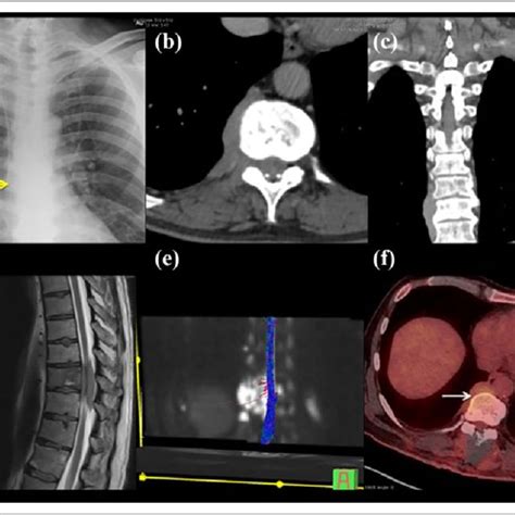 Brain Ct Shows Hypodensity In The Left Striatum With A Strong Download Scientific Diagram