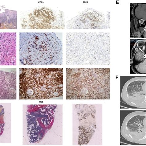 Pathological And Radiological Illustrations Of Ebv Induced Download Scientific Diagram