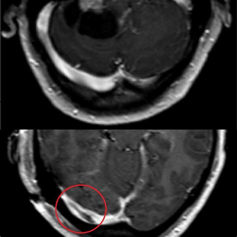 Grade 2—thrombus Fills Less Than The 50 Of The Cross Section Of Sinus