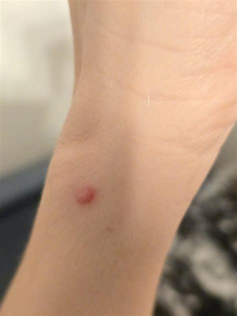 Showed Up Today Worried Its Bed Bugs Does Not Itch R