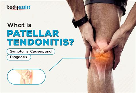 What Is Patellar Tendonitis Symptoms And Treatment