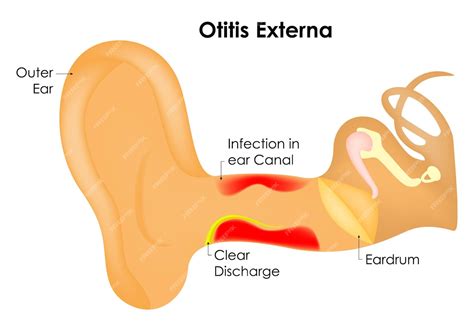 Premium Vector Otitis Externa Outer Ear Infection In Ear Canal Clear