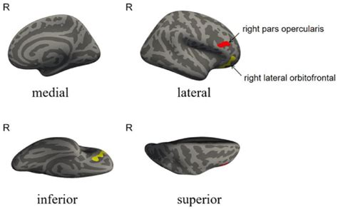 Altered Orbitofrontal And Pars Opercularis Cortical Thickness In Betel