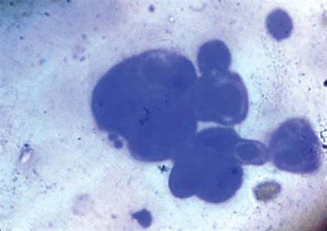 2020217herpessimplex Our Dermatology Online