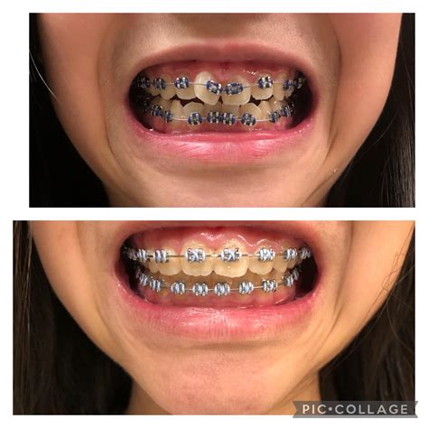 3 Months Braces Progress Rbraces