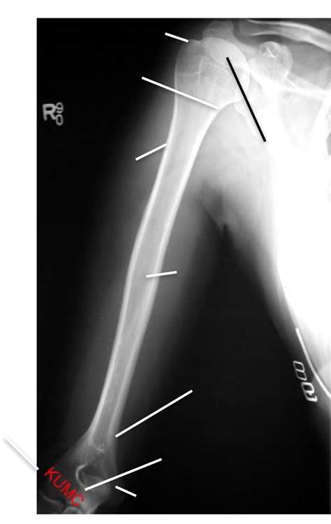 Ap Humerus Diagram Quizlet