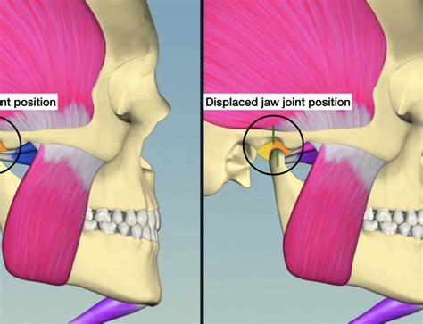 Temporomandibular Joint Dysfunction Symptoms And Treatments