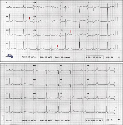 Ibuprofen Induced Distal Renal Tubular Acidosis And Hyporeninemic