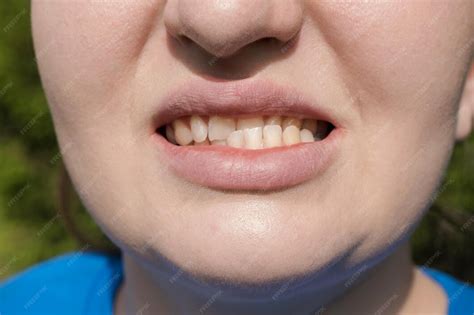 Premium Photo Patient Woman With Dislocated Jaw And Malocclusion Temporomandibular Joint