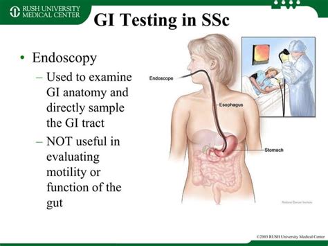 Scleroderma Systemic Sclerosis And The Gi Tract Pptx