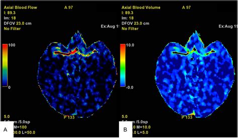 Computed Tomography Perfusion For The Diagnosis Of Brain Death A Technical Review Canadian