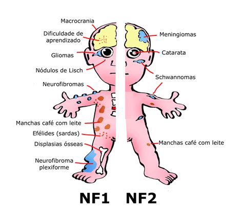Neurofibromatoses Dr Lor Semanalmente Quais As Diferenças Entre Nf1