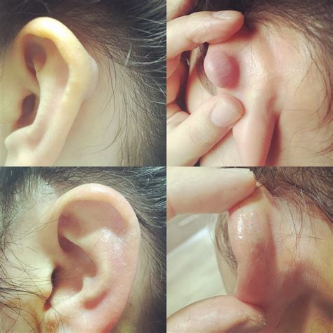 Tratamiento De Queloides Iort Chile