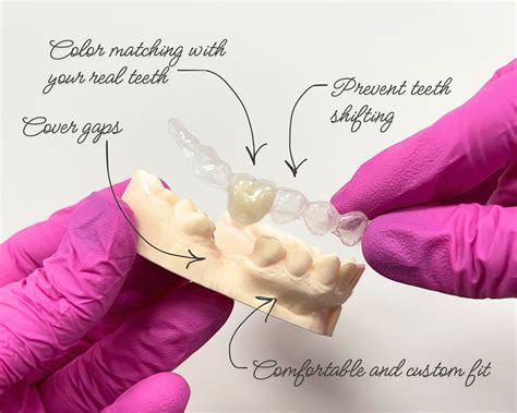 Essix Retainers With A Fake Tooth A Temporary Solution For Patients Awaiting Dental Implants