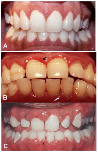Moderate Gingivitis Gum Disease Symptoms Stages Causes Treatment
