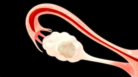 3d Oophorectomy Turbosquid 2309898