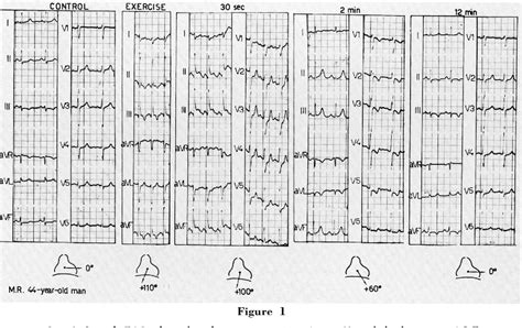 Figure 1 From Transient Left Posterior Hemiblock Semantic Scholar