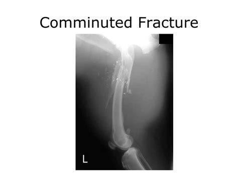 Ppt Orthopedics And Fractures Powerpoint Presentation Free Download
