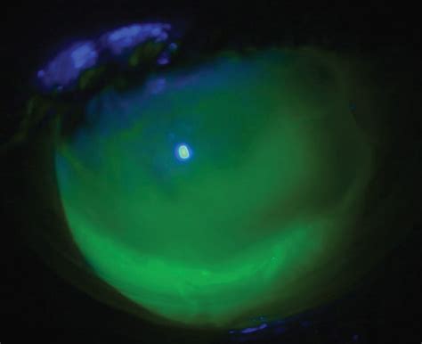 Amniotic Membrane For Dry Eye Contact Lens Spectrum