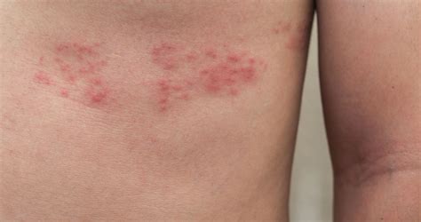 What Exactly Are Shingles Patients Er And Hospital