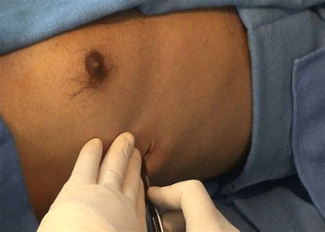 Exploring The Risks And Complications Of Tube Thoracostomy