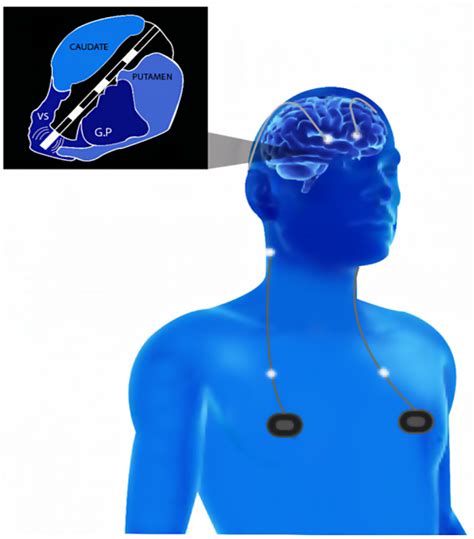 Schematic Drawing Of A Deep Brain Stimulation Dbs Multielectrode