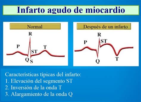 Infarto Agudo De Miocardio Ecg Diagnóstico Inferior Enzimas Y